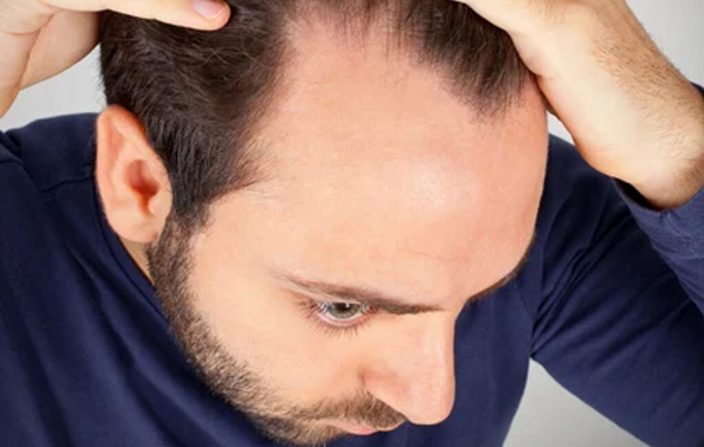 Alma TED Hair Restoration at REGEN Laser: A Breakthrough for Hair ...